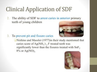 Silver diamine flouride | PPTX