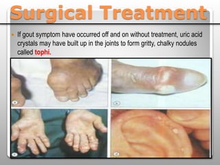 gout | PPTX | Digestive Disorders | Diseases and Conditions