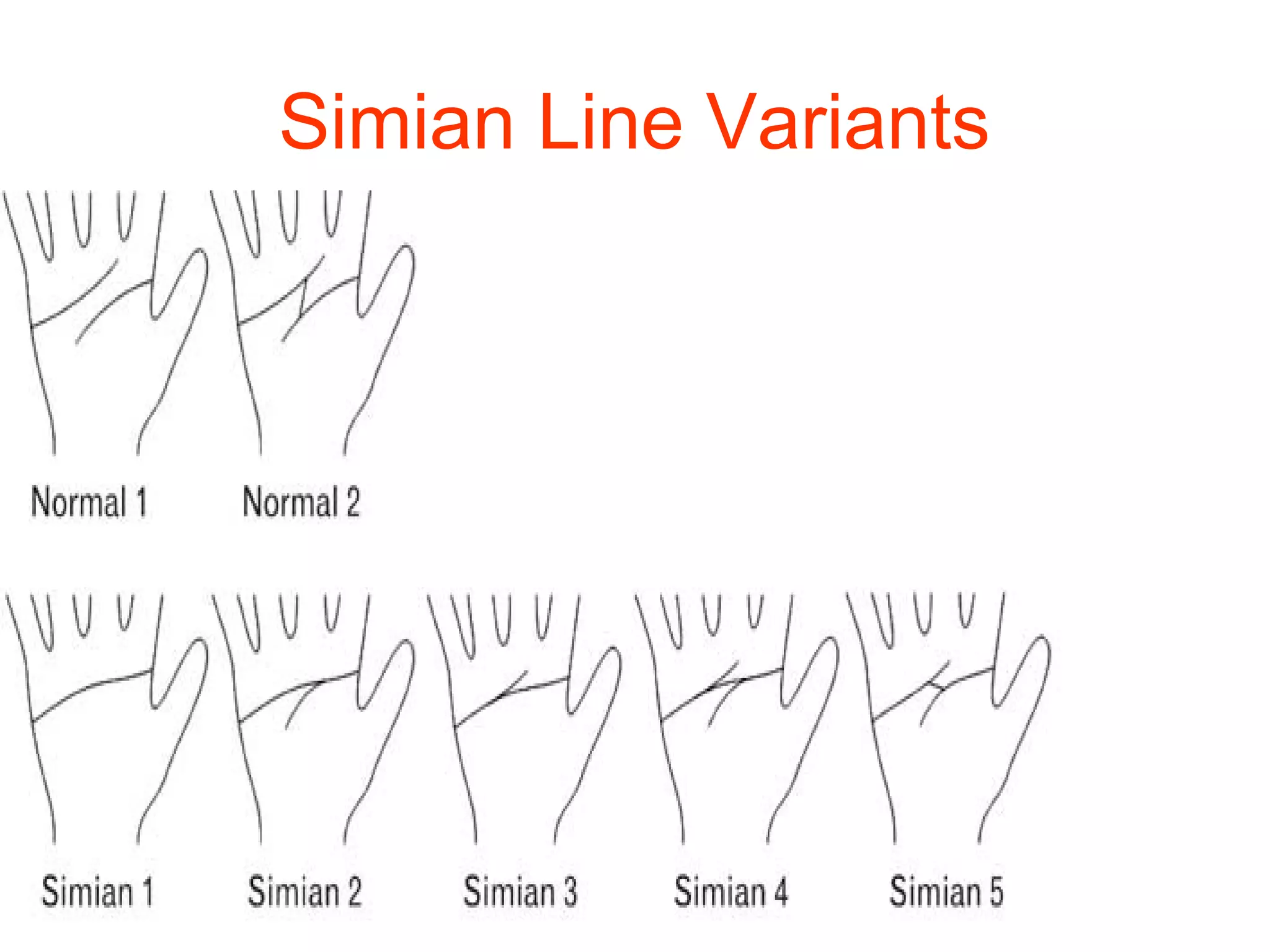 Simian line/crease | PPT