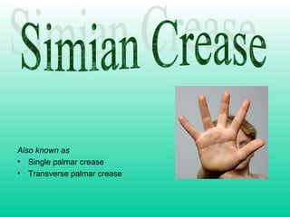 Simian line/crease | PPT