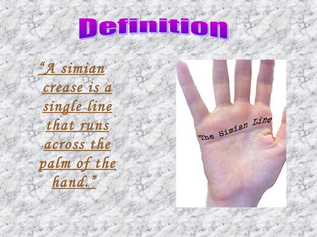 Simian line/crease | PPT
