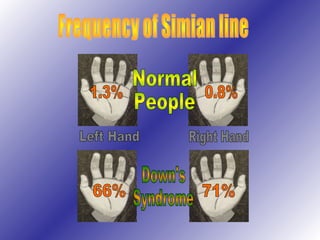 Simian line/crease | PPT