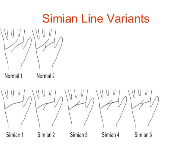 Simian line/crease