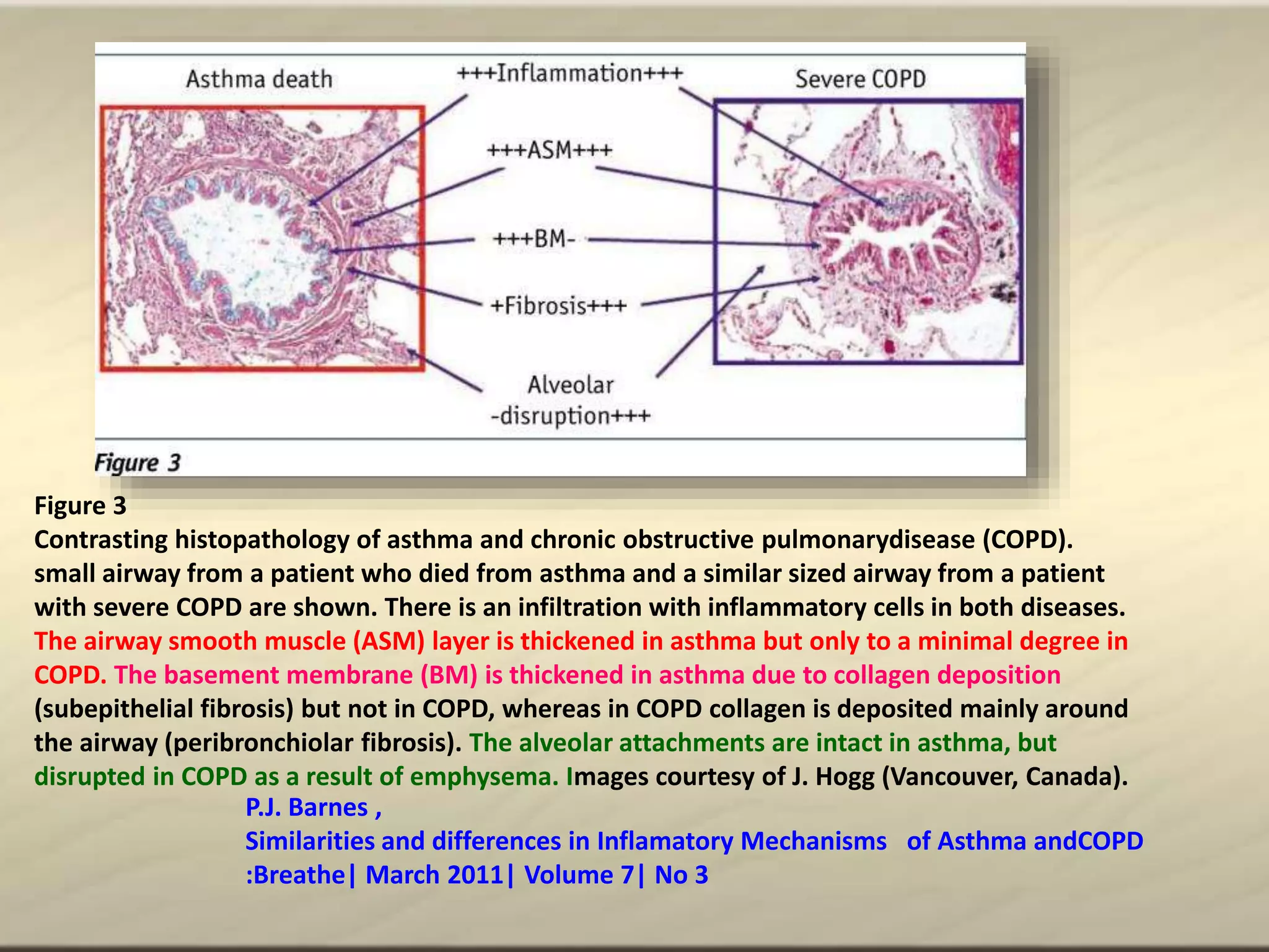 Similarities and differences between asthma and asthma masqueraders | PPTX
