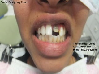 Simile designing case | PPT