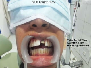 Simile designing case | PPT