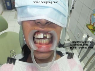 Simile designing case | PPT