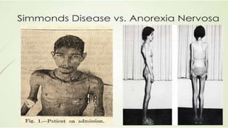 Simmonds Disease | PPTX
