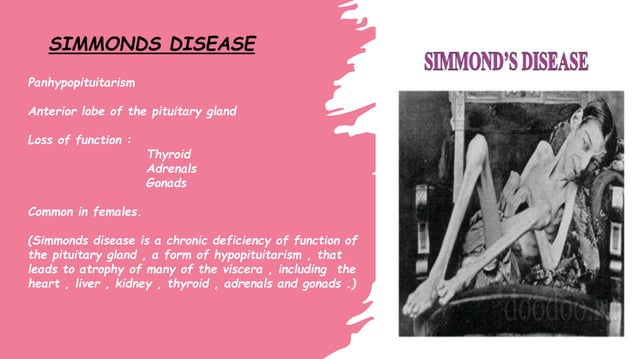 Simmonds Disease
