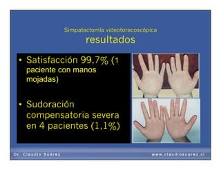 Simpatectomia Videotoracoscopica | PDF