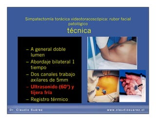 Simpatectomia Videotoracoscopica | PDF