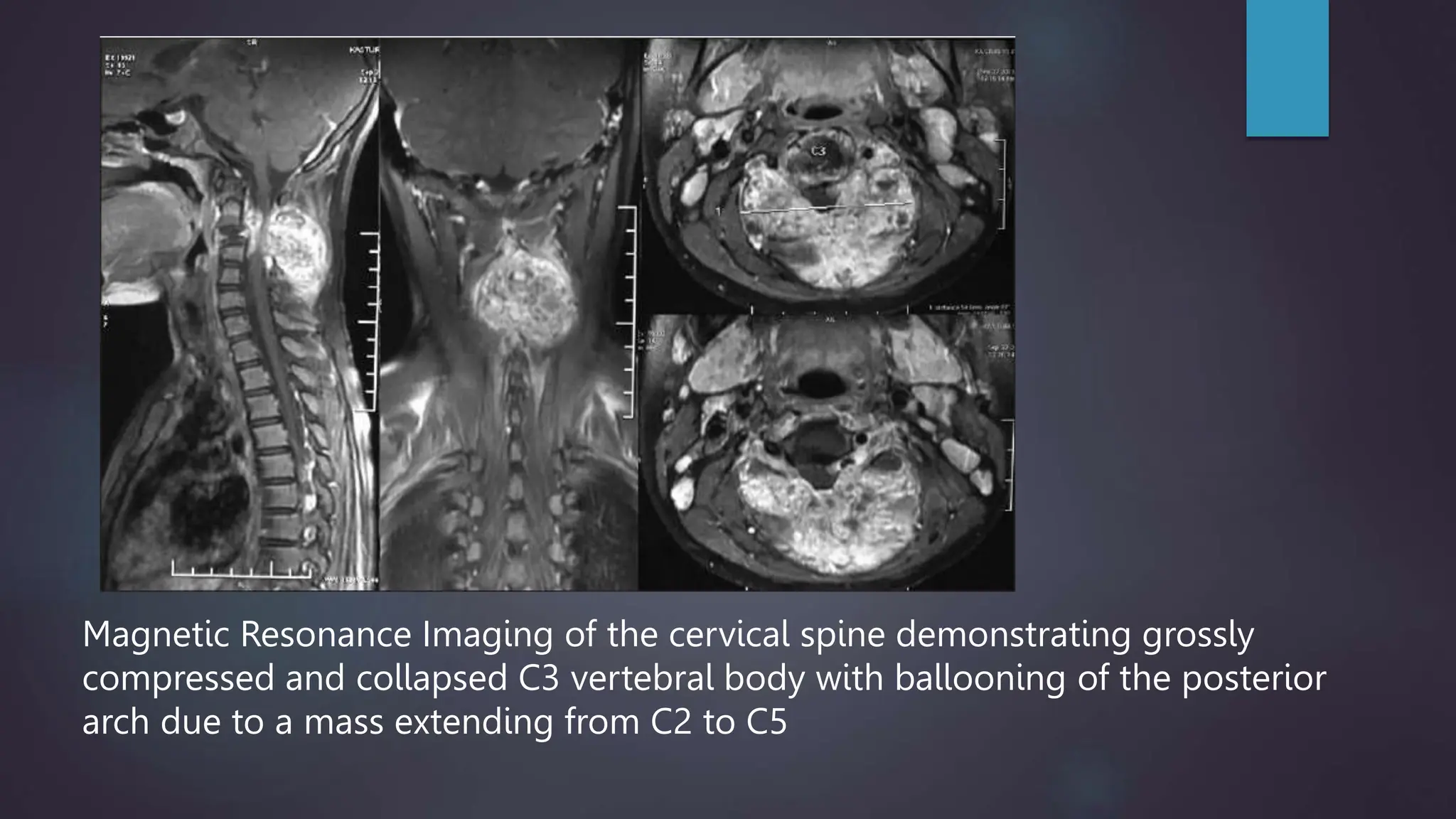 Simple and aneurysmal Bone cyst - Definition, Classfication ...