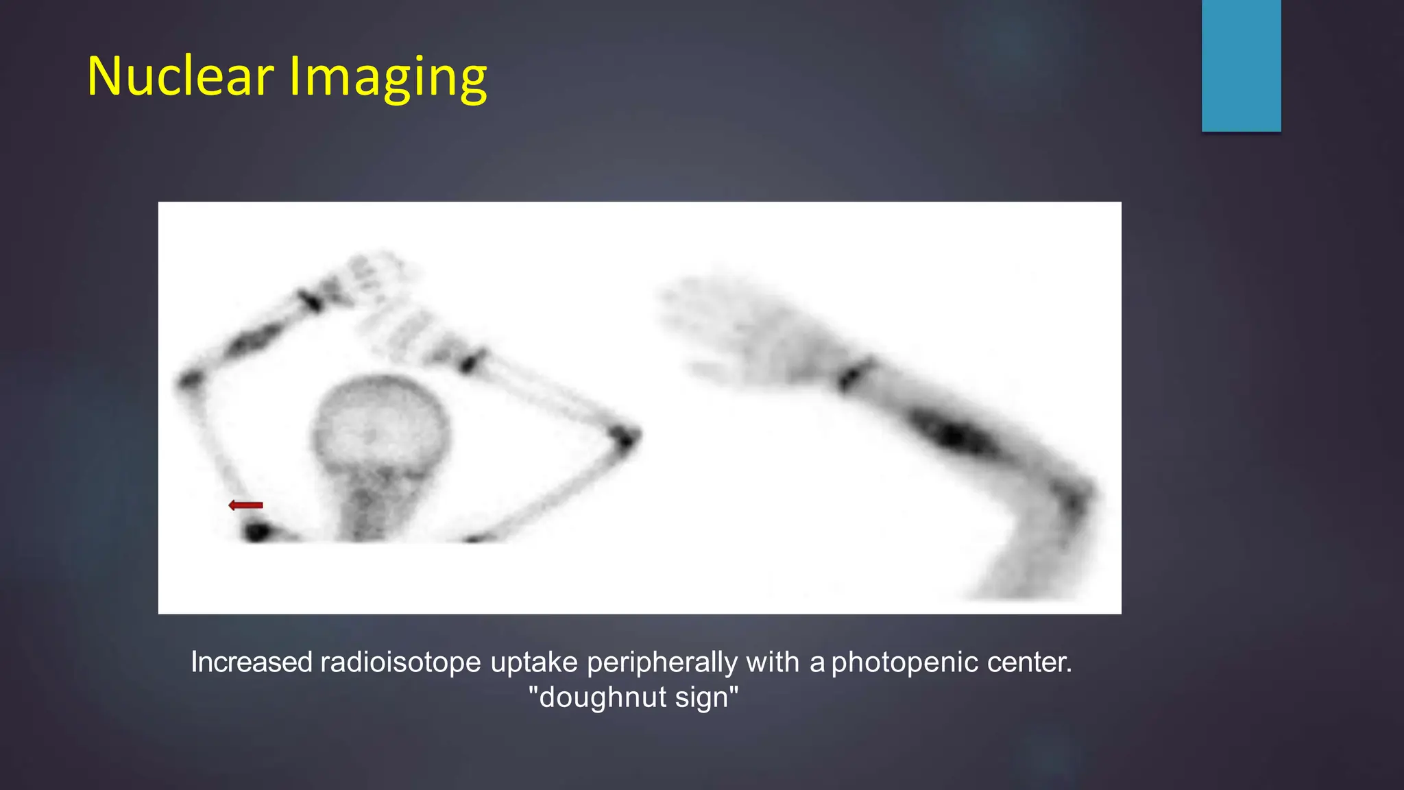 Simple and aneurysmal Bone cyst - Definition, Classfication ...