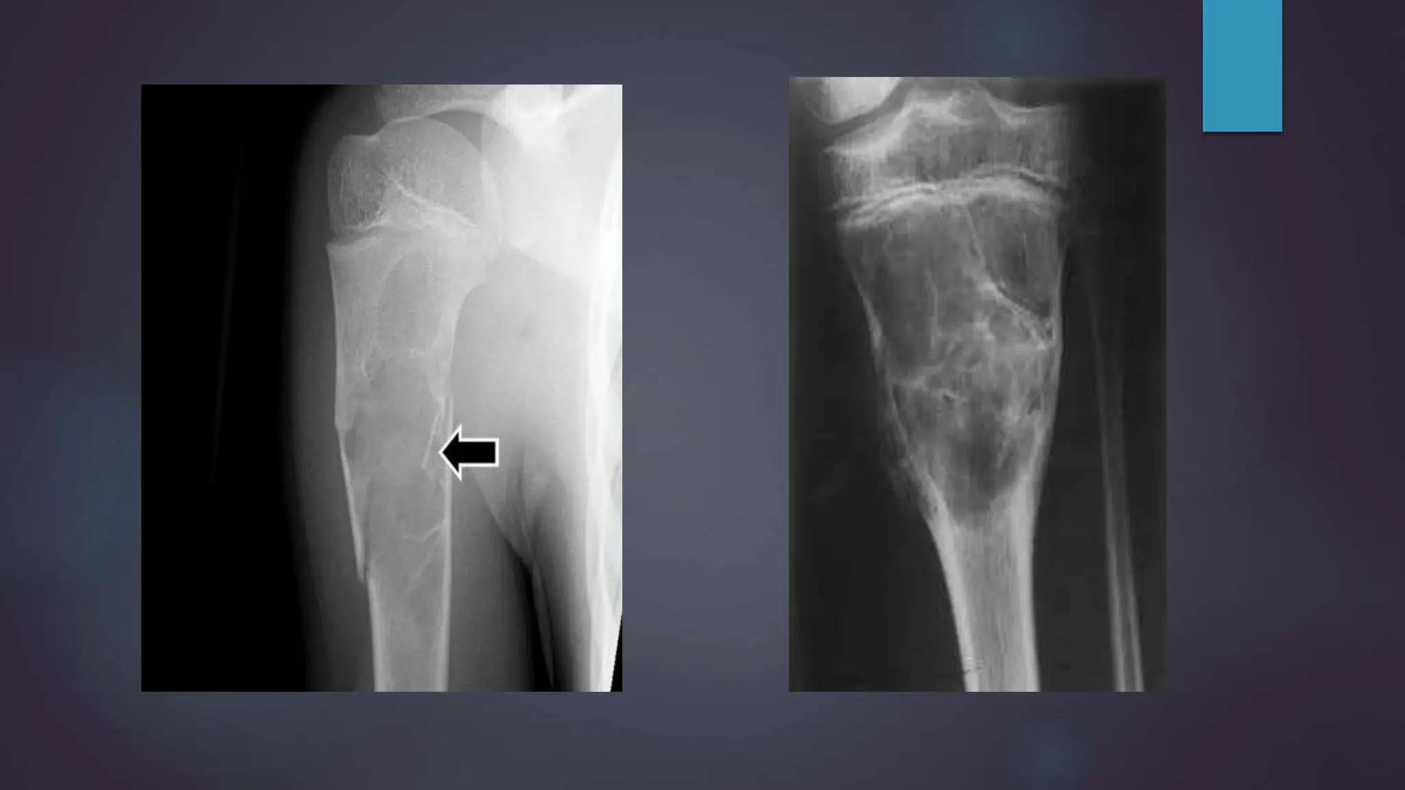 Simple and aneurysmal Bone cyst - Definition, Classfication, Investigations, treatment and DDs ...