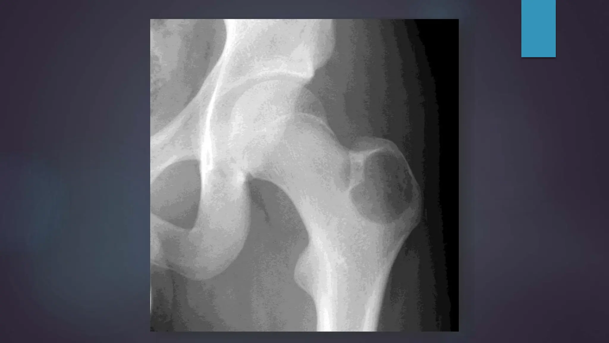 Simple and aneurysmal Bone cyst - Definition, Classfication ...