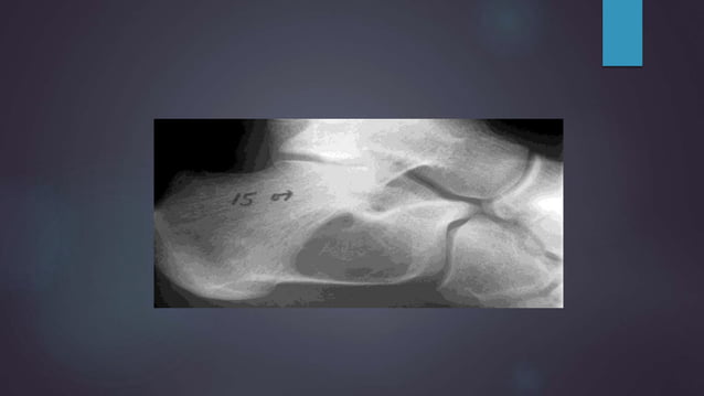 Simple and aneurysmal Bone cyst - Definition, Classfication ...
