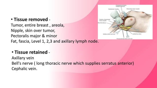 simple and radical mastectomy.pptx