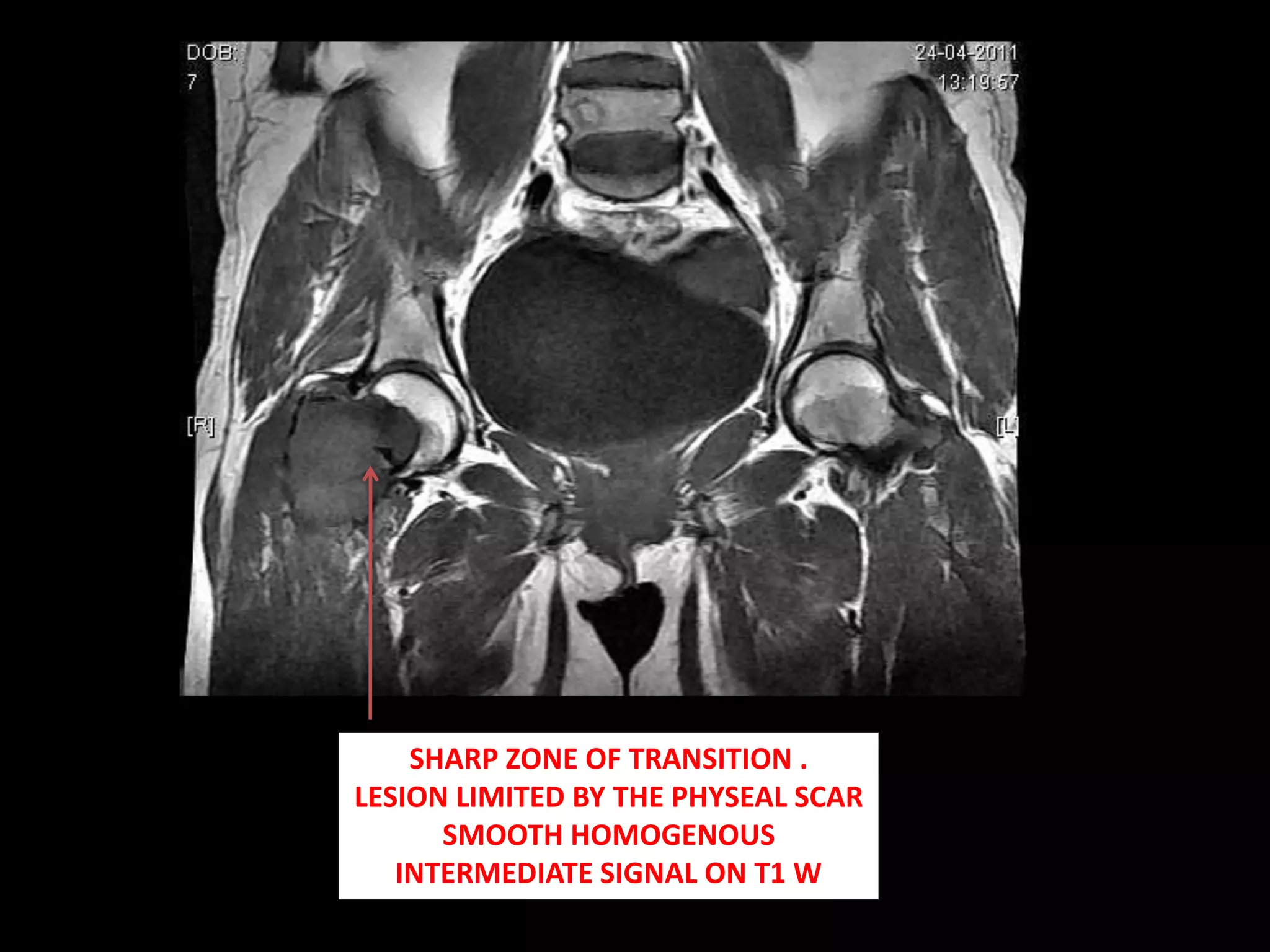 Simple bone cyst | PPTX