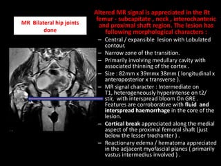 Simple bone cyst | PPTX