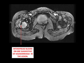 Simple bone cyst | PPT