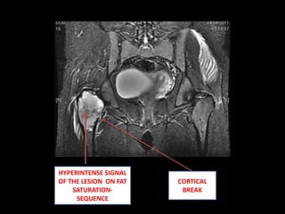 Simple bone cyst | PPTX