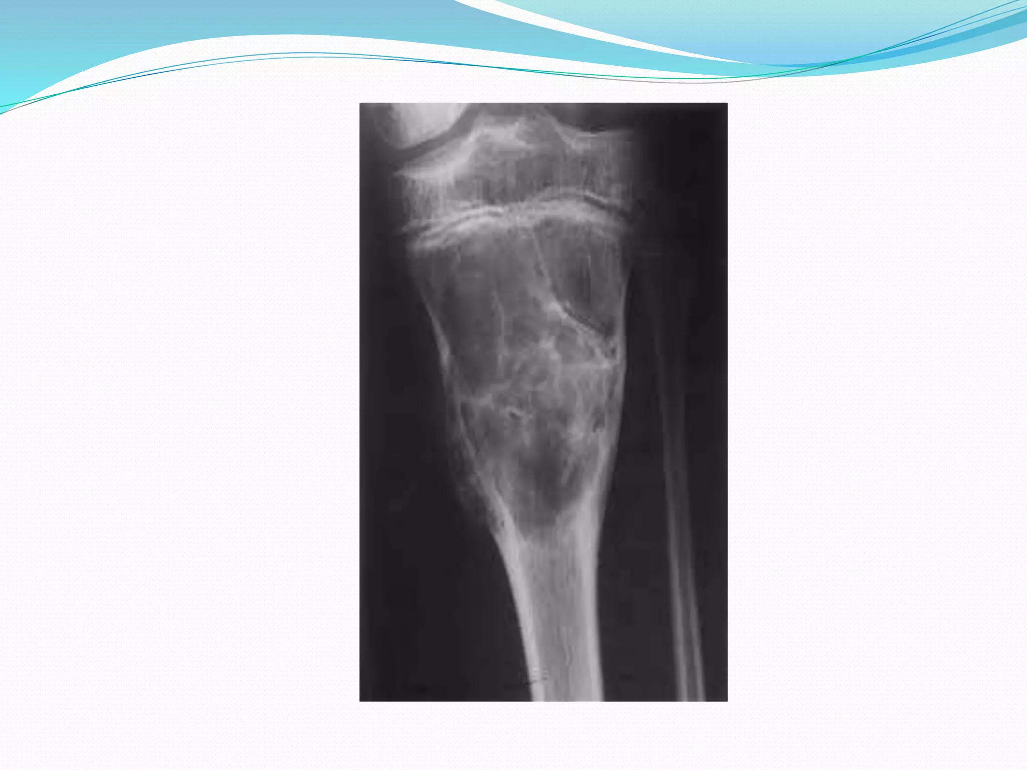 Simple bone cyst | PPTX