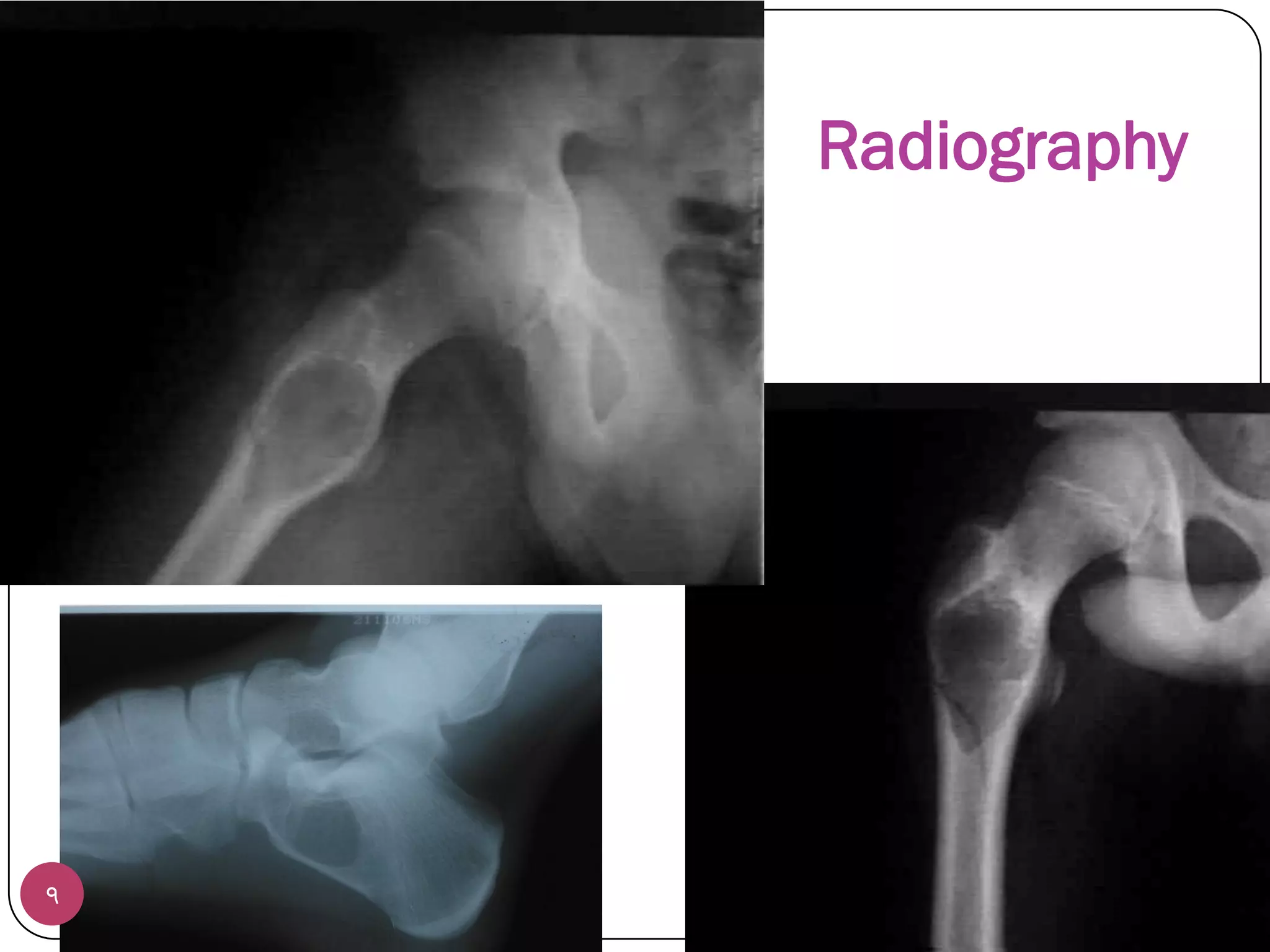 Simple bone cyst (unicameral) | PDF
