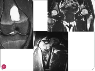 Simple bone cyst (unicameral) | PDF