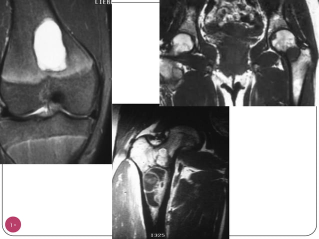 Simple bone cyst (unicameral) | PDF | Death, Injury, or Military ...