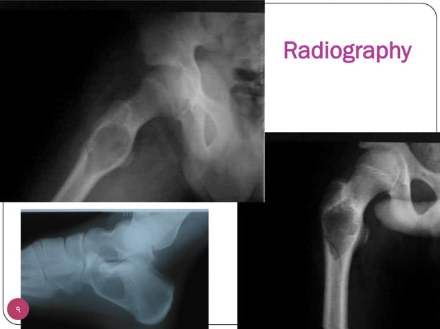 Simple bone cyst (unicameral) | PDF | Death, Injury, or Military ...