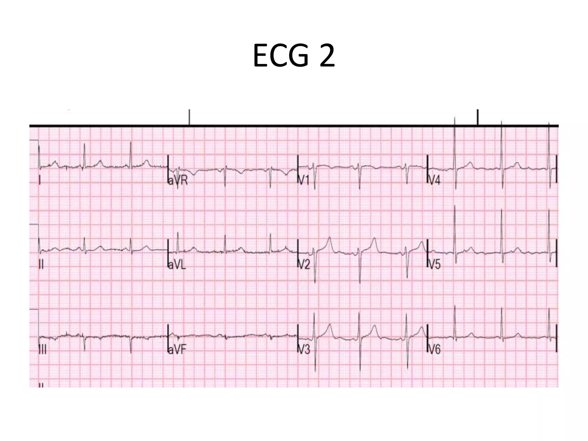 simple ecg learningMEM.pptx