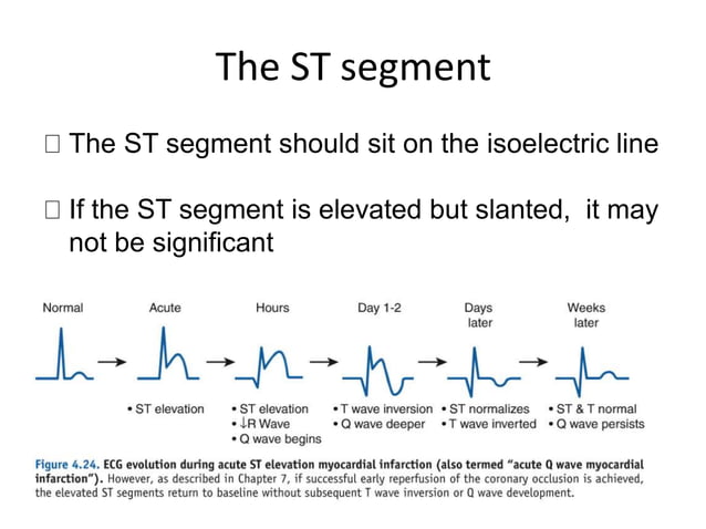 simple ecg learningMEM.pptx