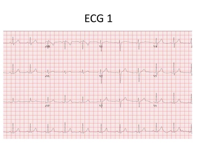 simple ecg learningMEM.pptx