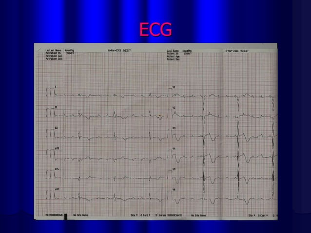 Simple errors...in ecg | PPT