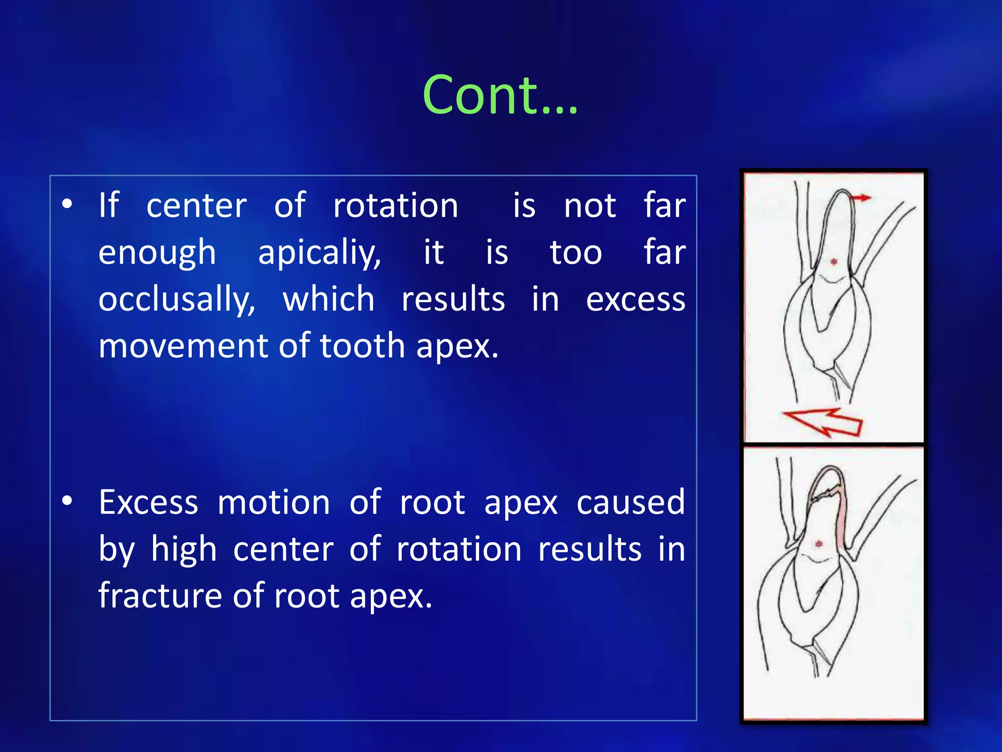 Simple tooth extraction technique | PPTX
