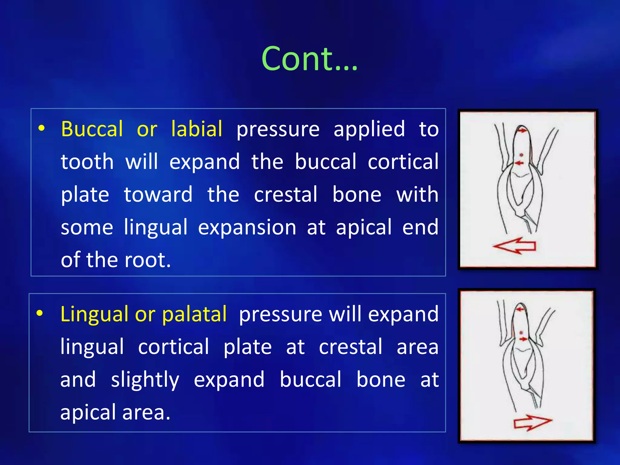 Simple tooth extraction technique | PPTX