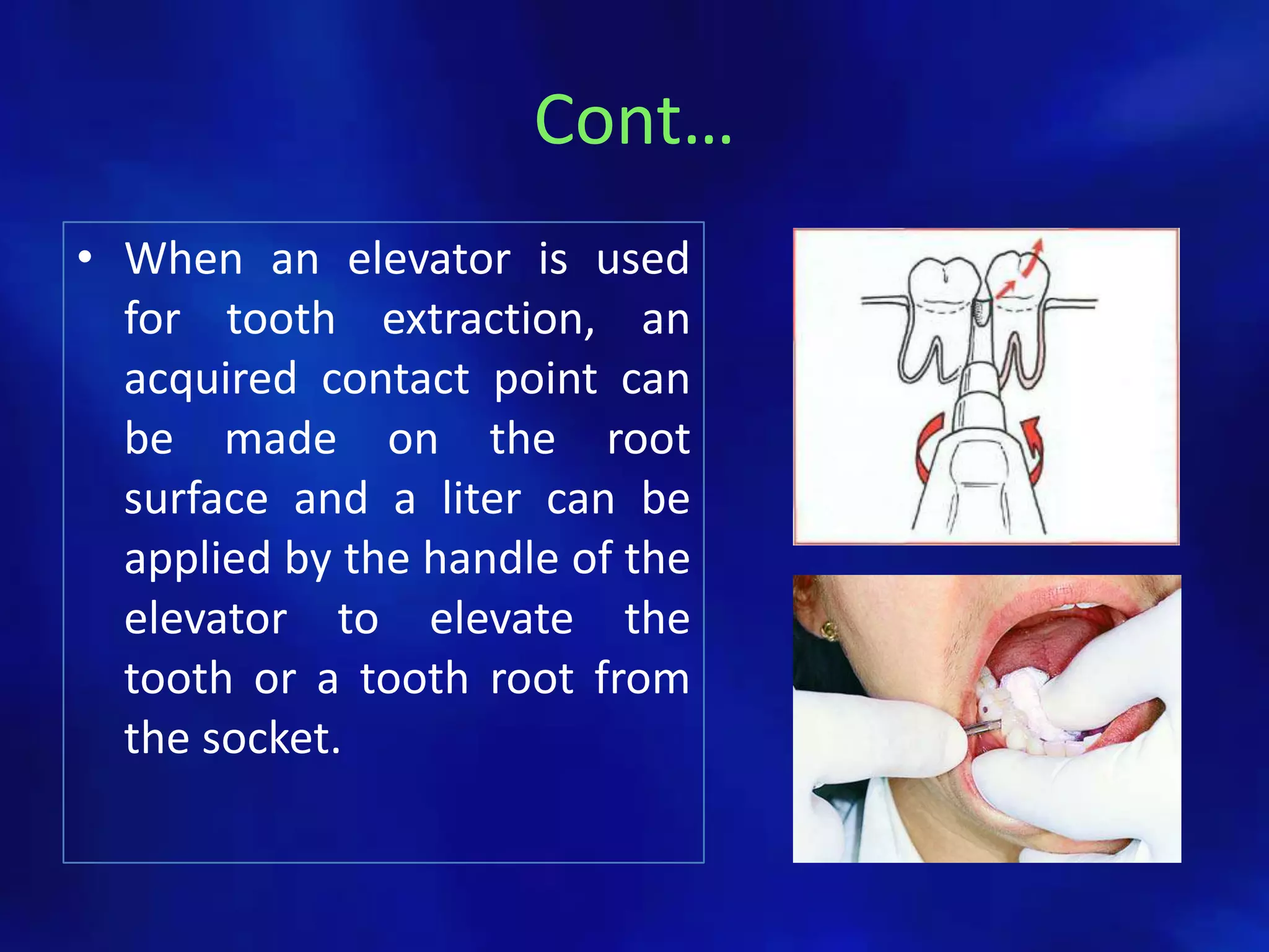 Simple tooth extraction technique | PPTX