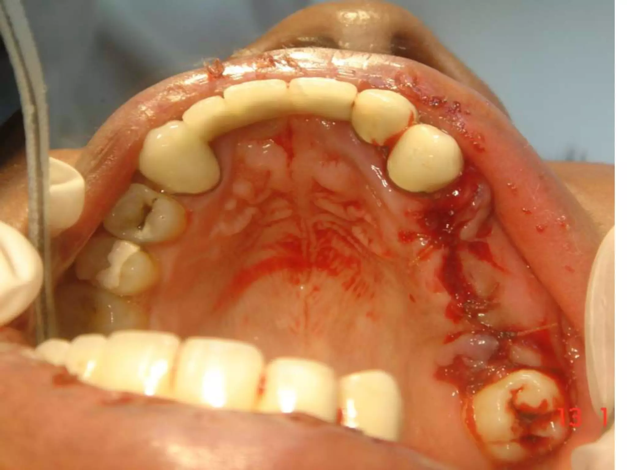 Simple surgical periodontic case | PPTX