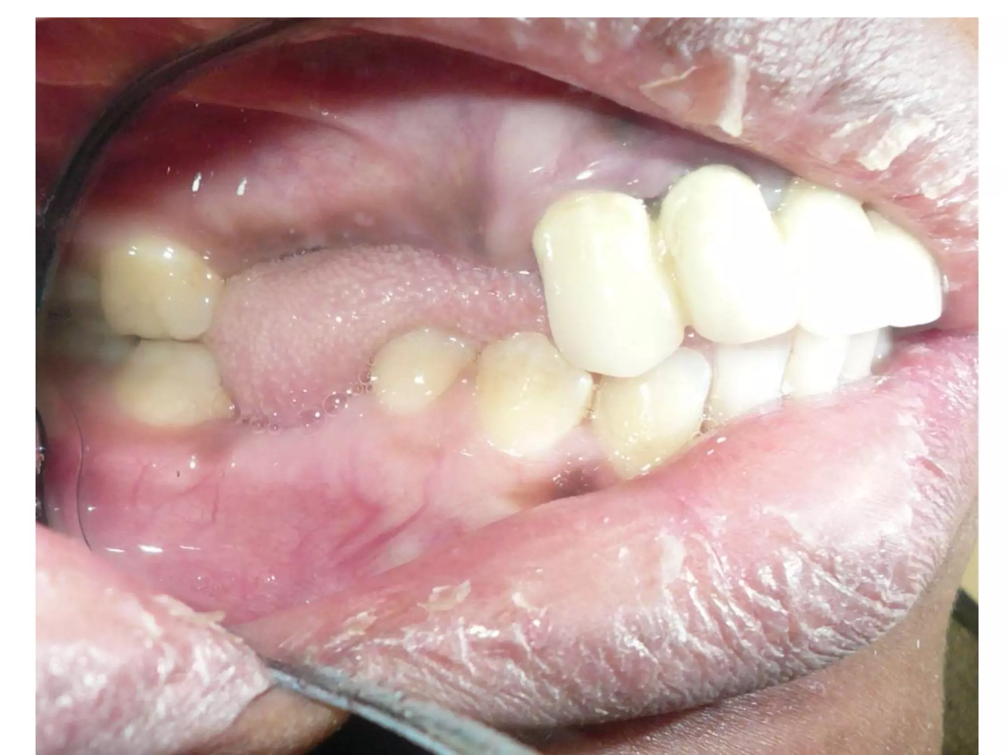 Simple surgical periodontic case | PPT