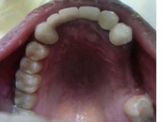 Simple surgical periodontic case | PPTX