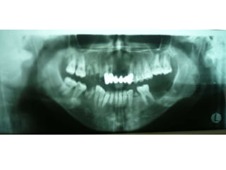 Simple surgical periodontic case | PPTX