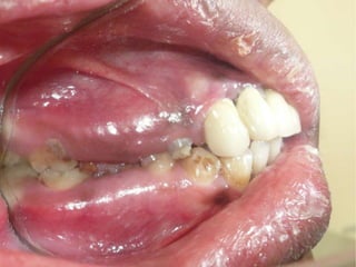 Simple surgical periodontic case | PPT