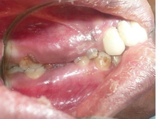 Simple surgical periodontic case | PPTX