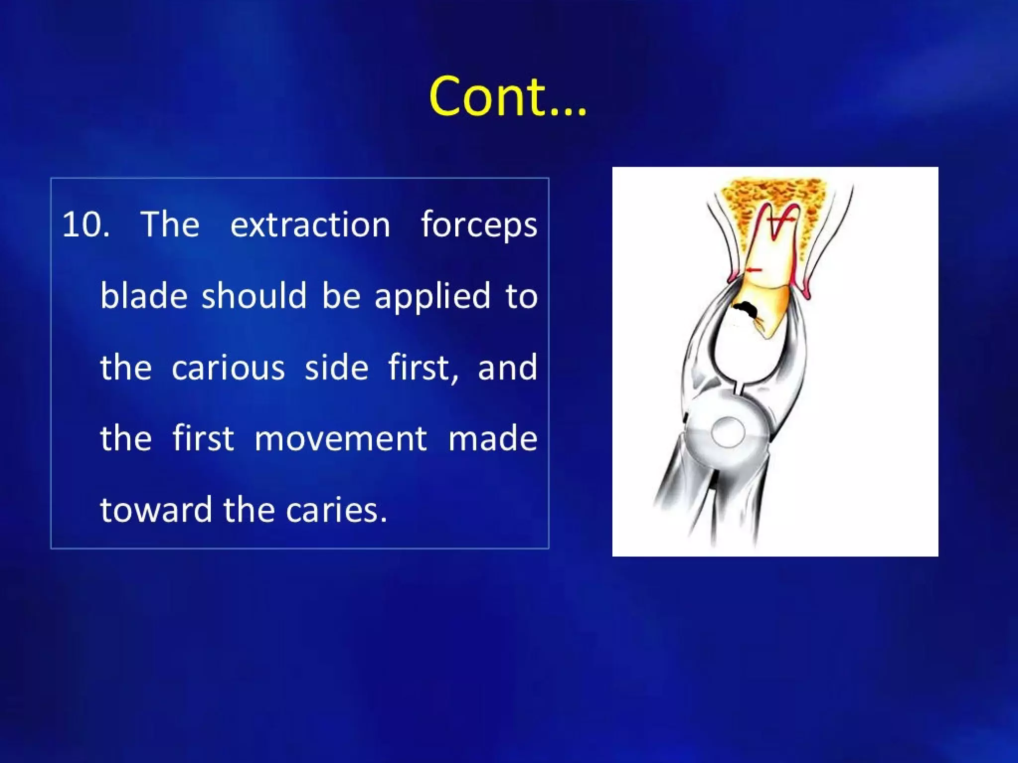 Simple tooth extraction | PPT