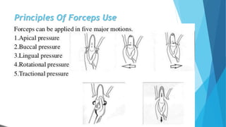 Tooth Extraction Simple Technique | PPTX