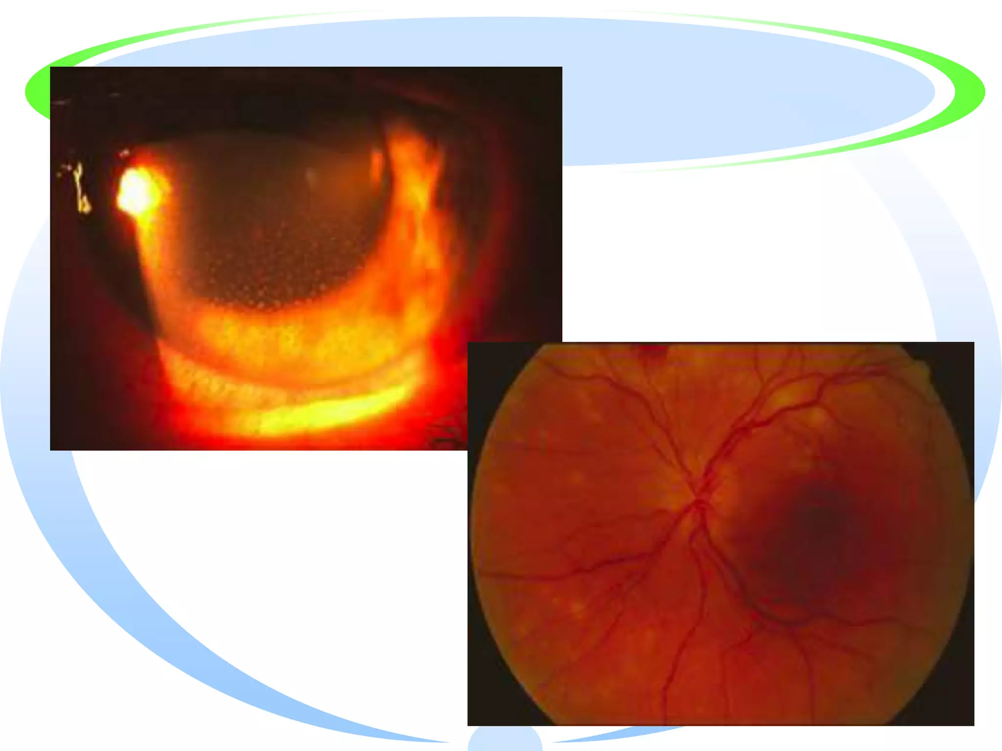Simple uveitis 1 | PPT