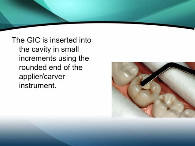 Simplified and modified atraumatic restorative treatment | PPT