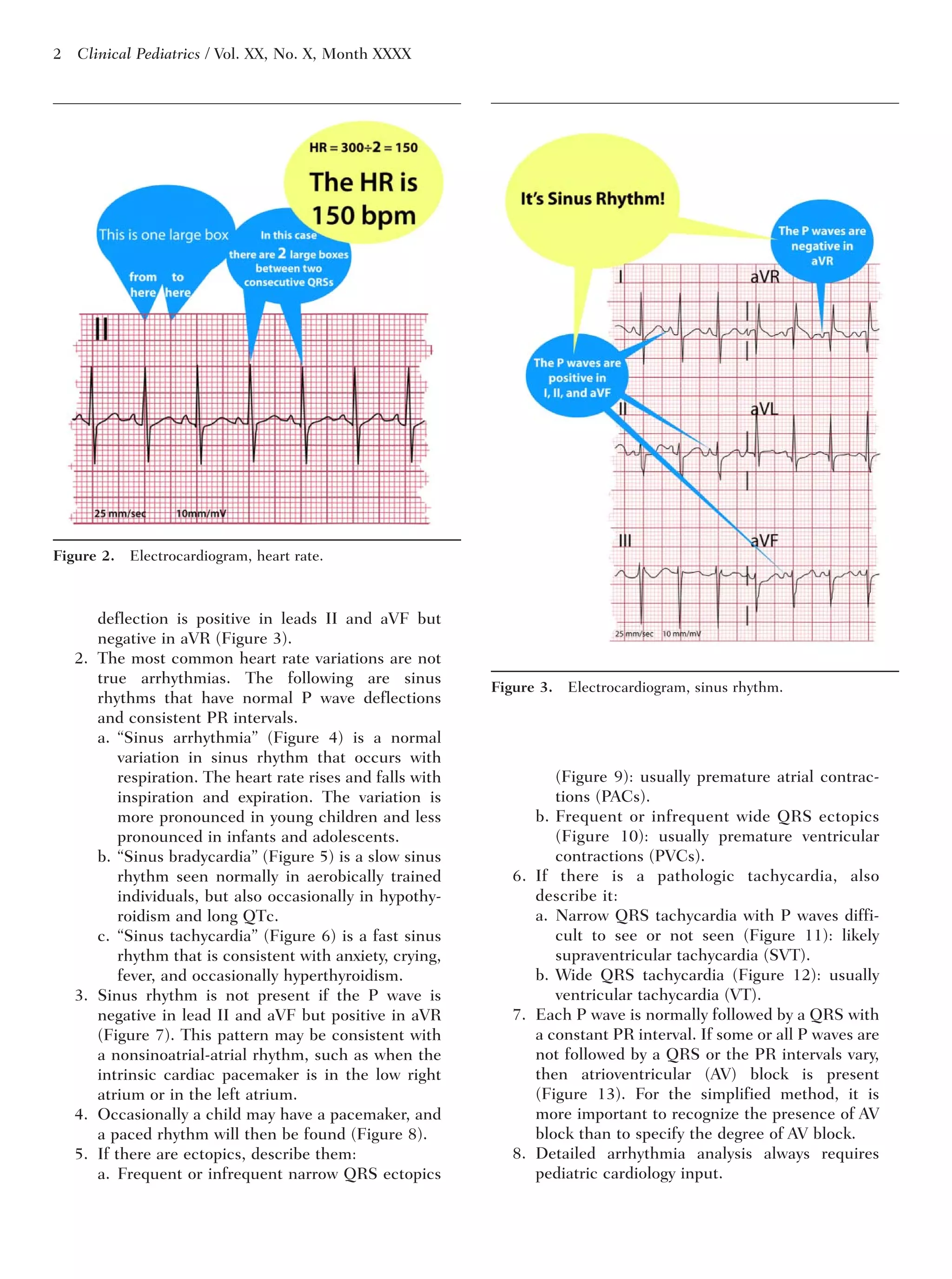 Simplified pediatric electrocardiogram interpretation | PDF