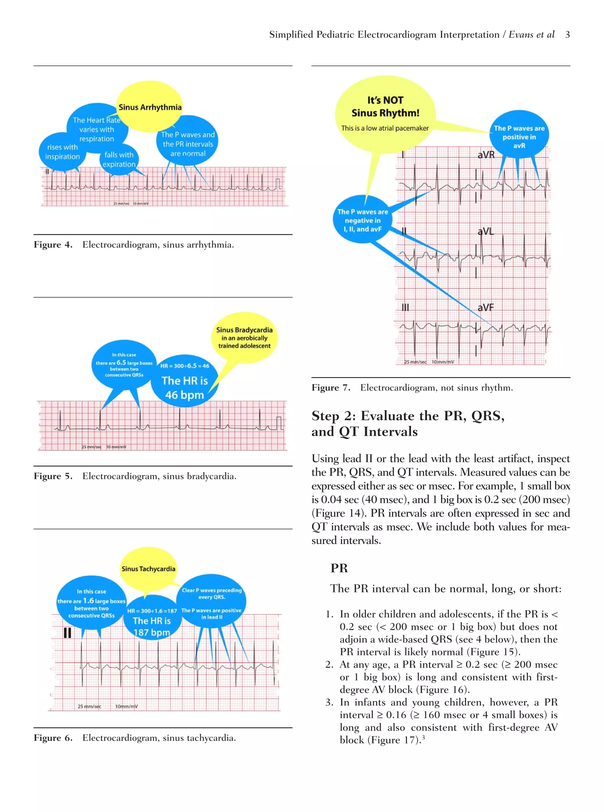Simplified pediatric electrocardiogram interpretation | PDF