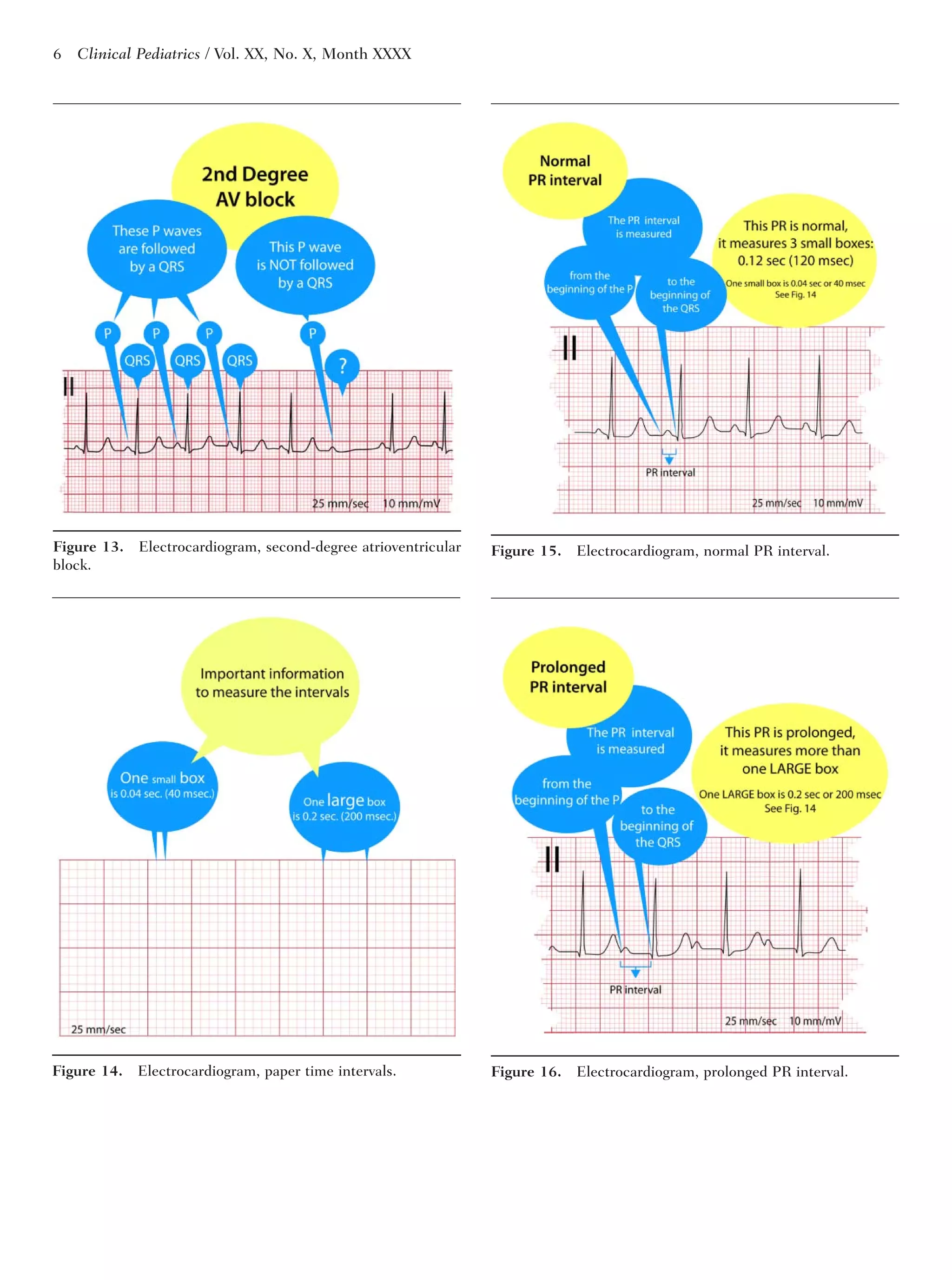 Simplified pediatric electrocardiogram interpretation | PDF